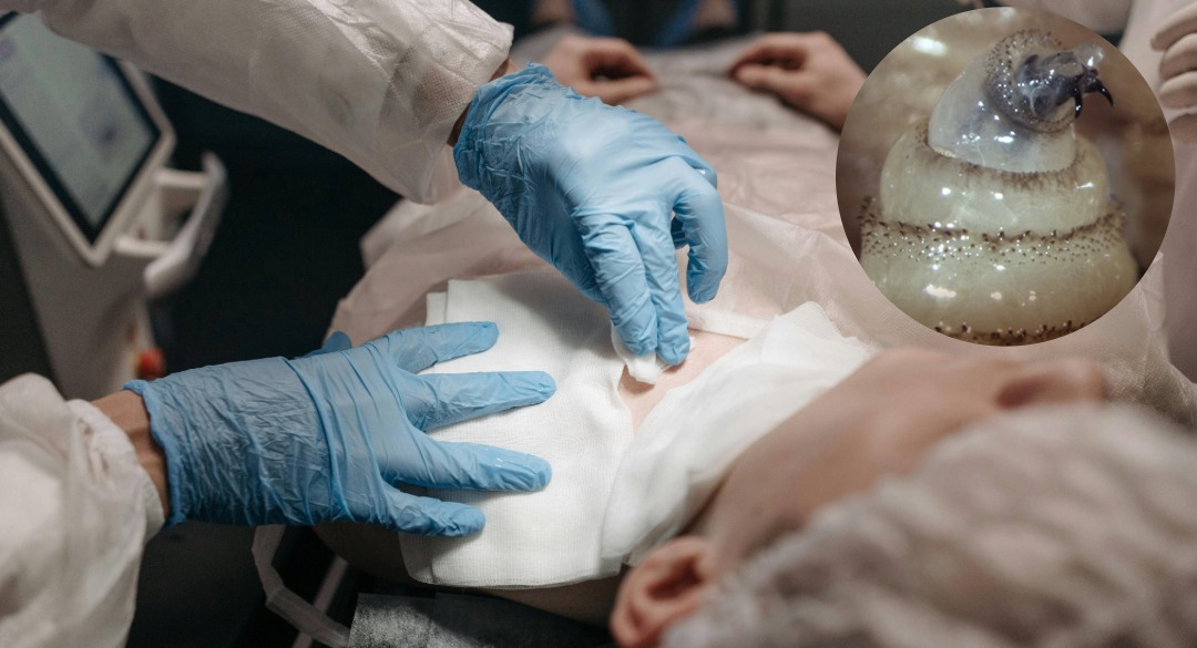 Muere paciente con miasis por gusano barrenador; Salud aclara que ...